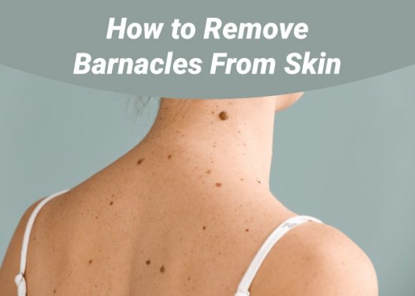 How to Remove Barnacles From Skin | Create your own story । Lifespeedsignup
